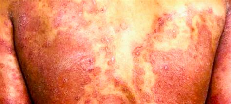 Silentsuperbug Info 2024 2025