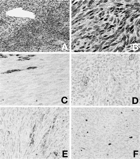 Figure 2 From Intraneural Synovial Sarcoma Originating From The Median Nerve Semantic Scholar