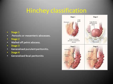 Diagnosis Of Diverticulosis And Diverticulitis Ppt Video Online Download
