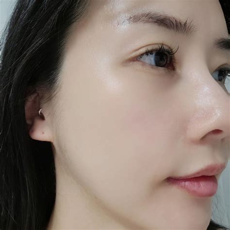 잠실역 피부과레이저 잡티관리 피코토닝 제네시스 5회차 경과 네이버 블로그