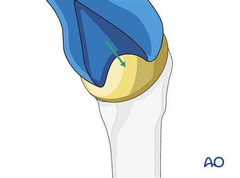Revision Of An Anatomic All Polyethylene Glenoid Component For Glenoid