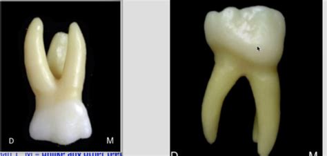 Board Dental Anatomy Calcification And Root Formation Primary Tooth