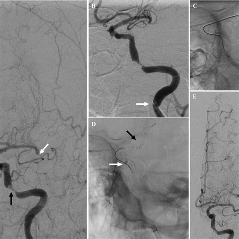 A Dsa Of The Left Common Carotid Artery Showing Severe Left Ica