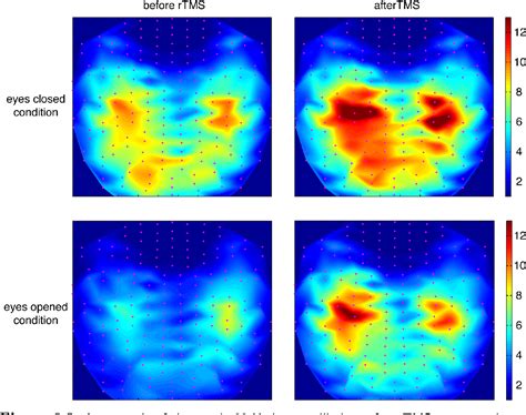 Figure 69 From Probing Cortical Excitability With Transcranial Magnetic Stimulation Semantic