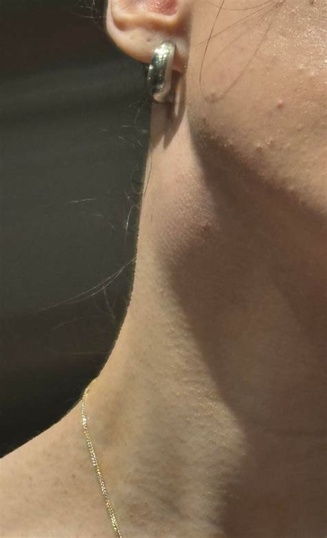 Lump On Lymph Node R Medical Advice