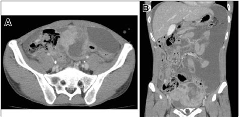 Ct Performed 7 Days After Admission Shows Ascites In The Abdominal