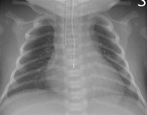Endotracheal Tube Xray
