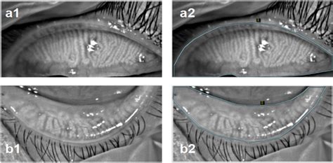Representative Images Of Conjunctiva Area Manual Annotations A1 A