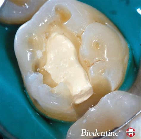 Biodentine Septodont Styleitaliano Org