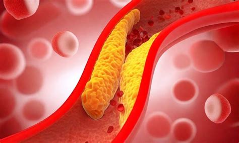 Điều Trị động Mạch Vành Nong Bóng Phủ Thuốc Và đặt Stent Phương Pháp