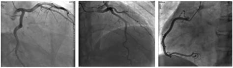 Angiography Image Frequent Pleomorphic Ventricular Tachycardia And Download Scientific