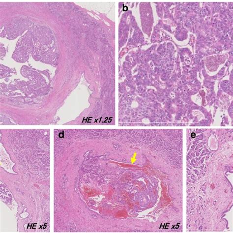 Histopathological Findings Of The Resected Specimens In The Second