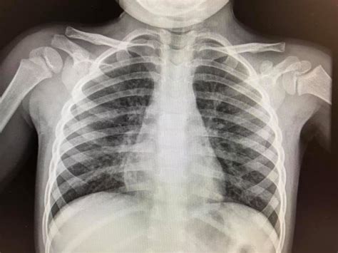 ปอดอักเสบ จากเชื้อไข้หวัดใหญ่ Infectious ง่ายนิดเดียว