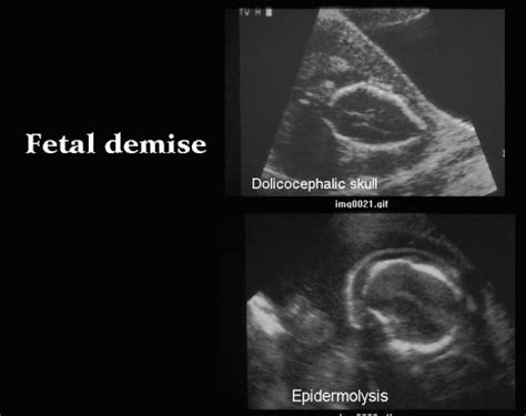Lithopedion JungleKey Fr Image 200