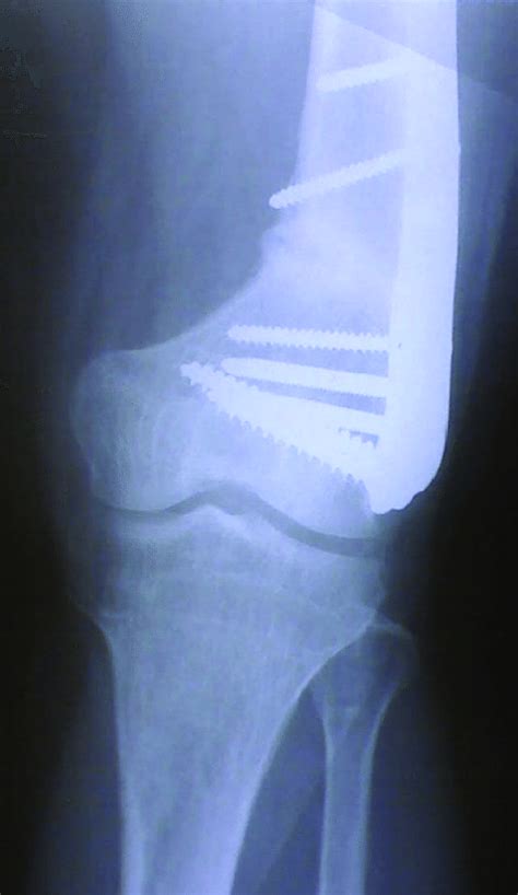 Figure1 Lateral Open Wedge Osteotomy Medialized The Trochlear Groove
