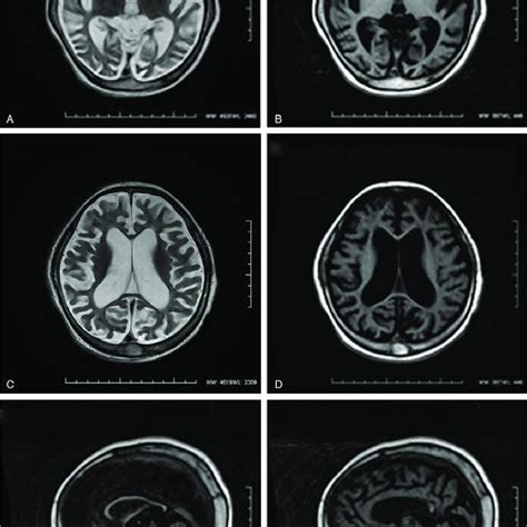 A D Diffuse Brain Atrophy E F Corpus Callosum Atrophy Skull Download Scientific Diagram