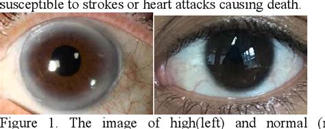 Figure 1 From Cholesterol Level Detection Based On Iris Recognition