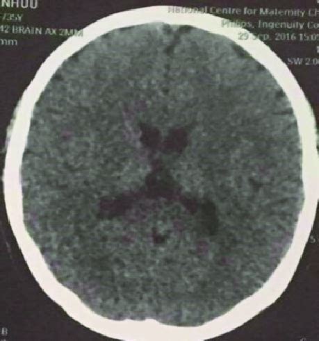 Initial CT Scan Days After The Insult Diffuse Brain Edema Without Download Scientific