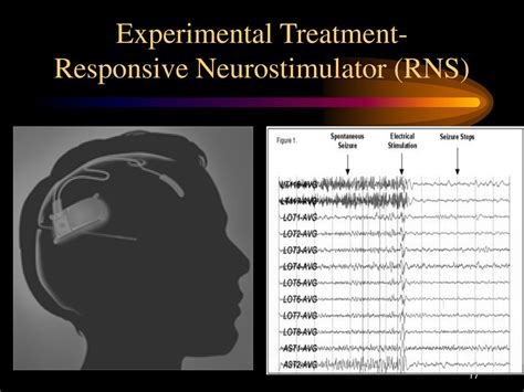 Seizures And Epilepsy Dr Tariq Saeed Ppt Download