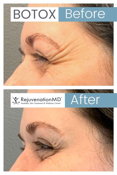 Botox Before And After Crows Feet Botox Botox Cosmetic Botox