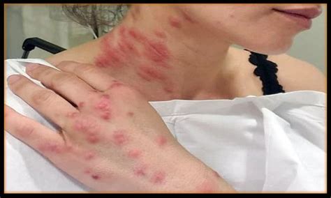 Allergic Reaction To Bed Bugs Pictures Bed Bugs Pics