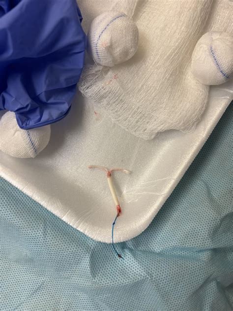 Kyleena Iud Crooked In Uterus R Copperiud