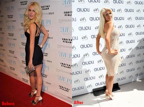 Heidi Montag Butt Augmentation Plastic Surgery Before And After