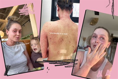 Mikayla Matthews Says Her Chronic Illness Experience Was Cut From The