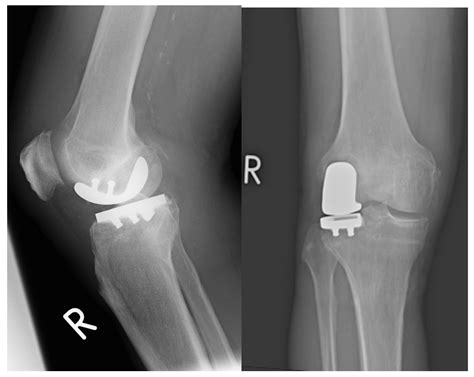 Survival Of Patient Specific Unicondylar Knee Replacement