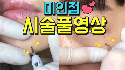 미인점 시술풀영상 두명 영상 Youtube
