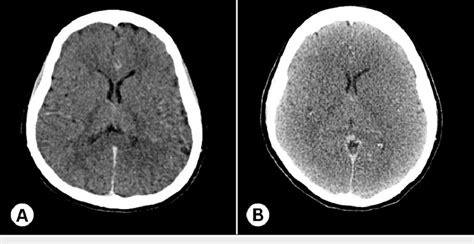 Computed Tomography Imaging Of The Brain A No Evidence Of Hemorrhage