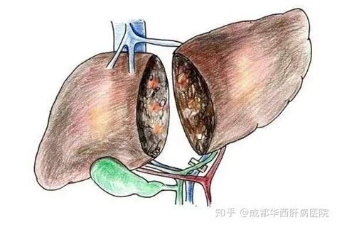 得了肝硬化腹水就只有等死 知乎