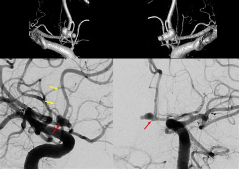 Acom Aneurysm Coiling Subcallosal Artery Threatened Occlusion And