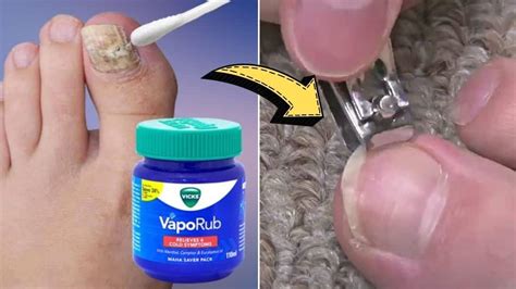 Vicks Vapor Rub Toe Nail