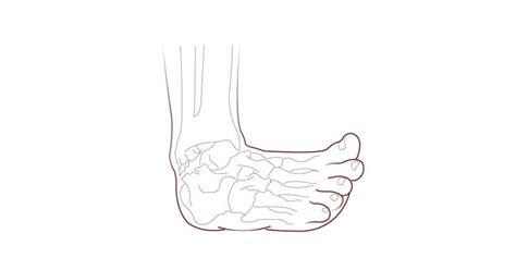 Complete Guide On Ankle Arthritis By London Foot And Ankle Surgery