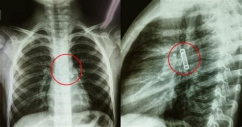 석 달째 기침5세 아이 폐 엑스레이 찍었다가 기겁