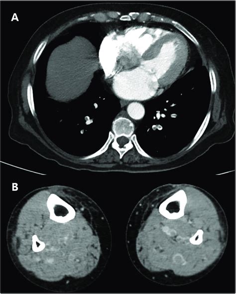 A Pulmonary Embolism In Both Subsegmental Pulmonary Arteries Of Both