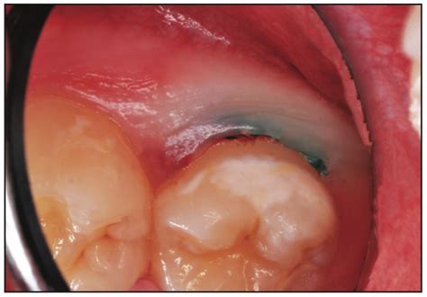 Smooth Surface Dental Caries And Decalcification Restoration And