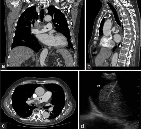 Pulmonary Artery Intimal Sarcoma Diagnosed Using Endobronchial Ultrasound Guided Transbronchial