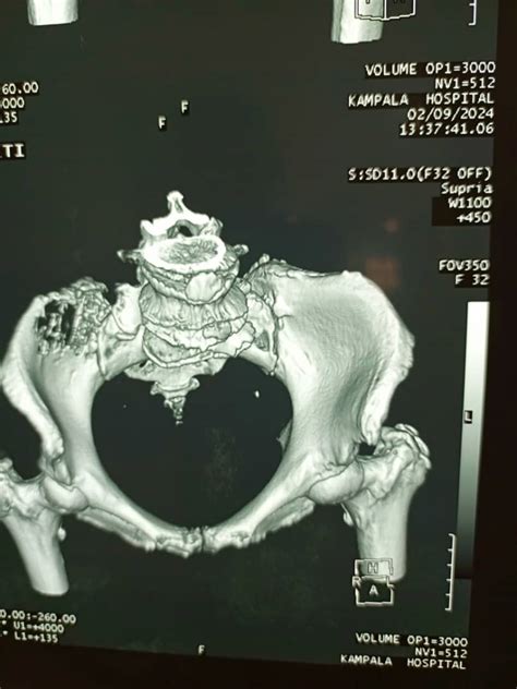X Ray Images Orthofixbonecare
