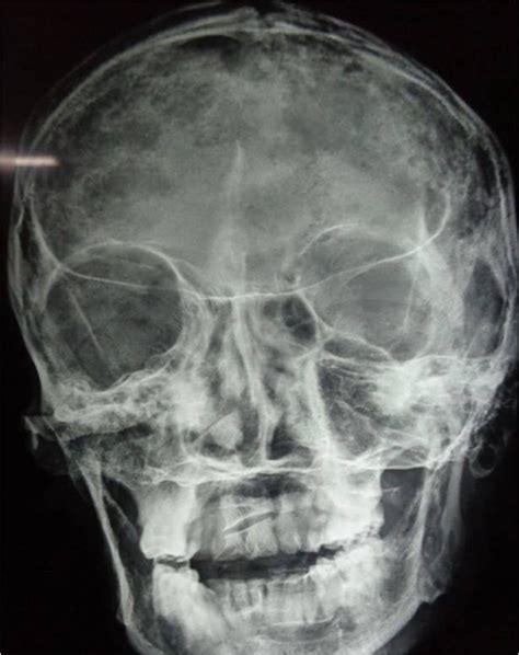 Diagnostic Dilemma In A Case Of Osteolytic Lesions Bmj Case Reports