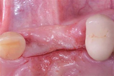 Lateral Block Augmentation In The Posterior Maxilla With Cancellous Maxgraft® Block Botiss