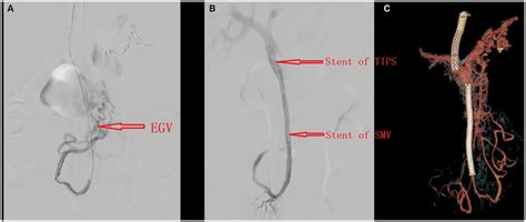 Angiography Before A And After B Tips Placement Ct Angiography