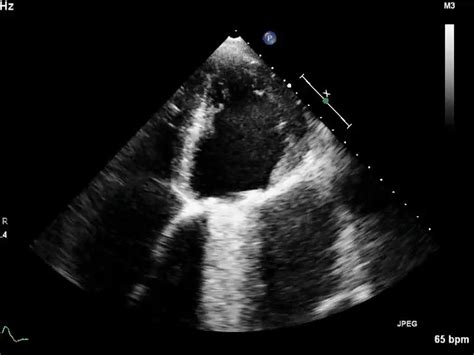 Left Atrial Appendage Thrombosis Discovered By Transthoracic