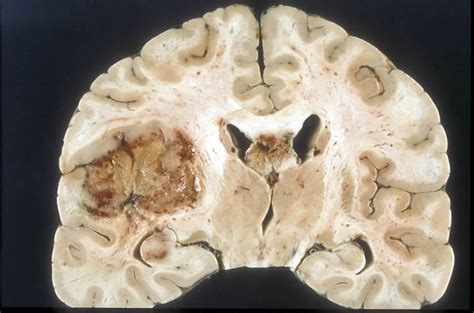 Real Human Brain Tumor