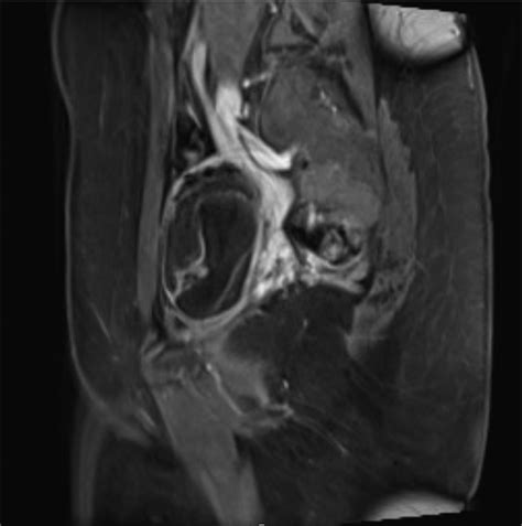 Sagittal T1 Weighted Image T1wi Postcontrast Sequence Shows An