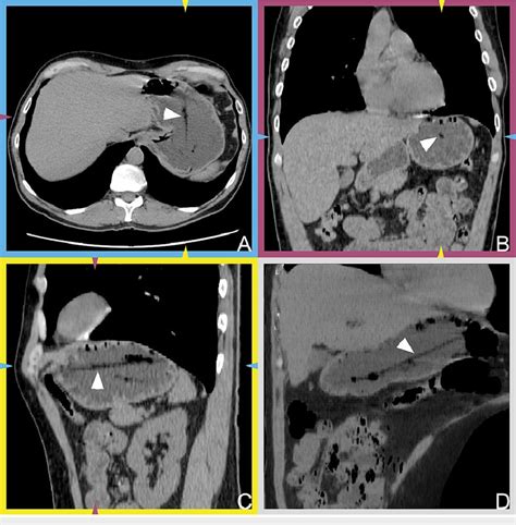 Multiplanar Reconstructions Of Computed Tomography Scans A C