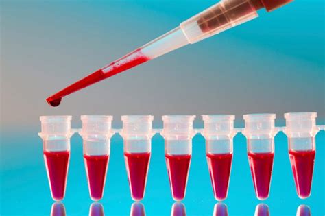 Identifican anticoagulante que retrasa la aparición del Alzheimer e