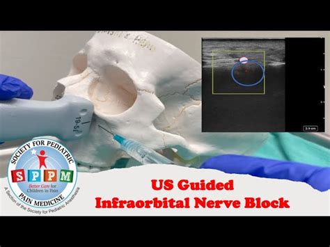 Infraorbital Nerve Block Landmarks