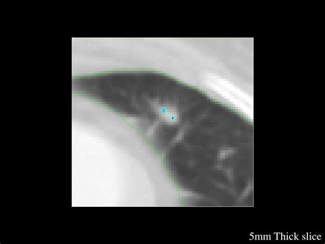 Ppt Cad Performance Analysis For Pulmonary Nodule Detection Comparison Of Thick And Thin